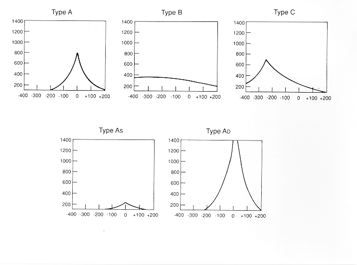 Tympanometry Type B Bilateral At Maryellen Kiefer Blog