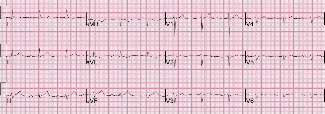 Dr. Smith's ECG Blog: Inferior hyperacute T-waves. The clue is T-wave ...