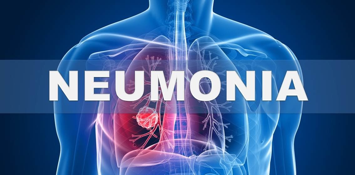 FISIOPATOLÓGICA DE LA NEUMONÍA - BIENVENIDOS