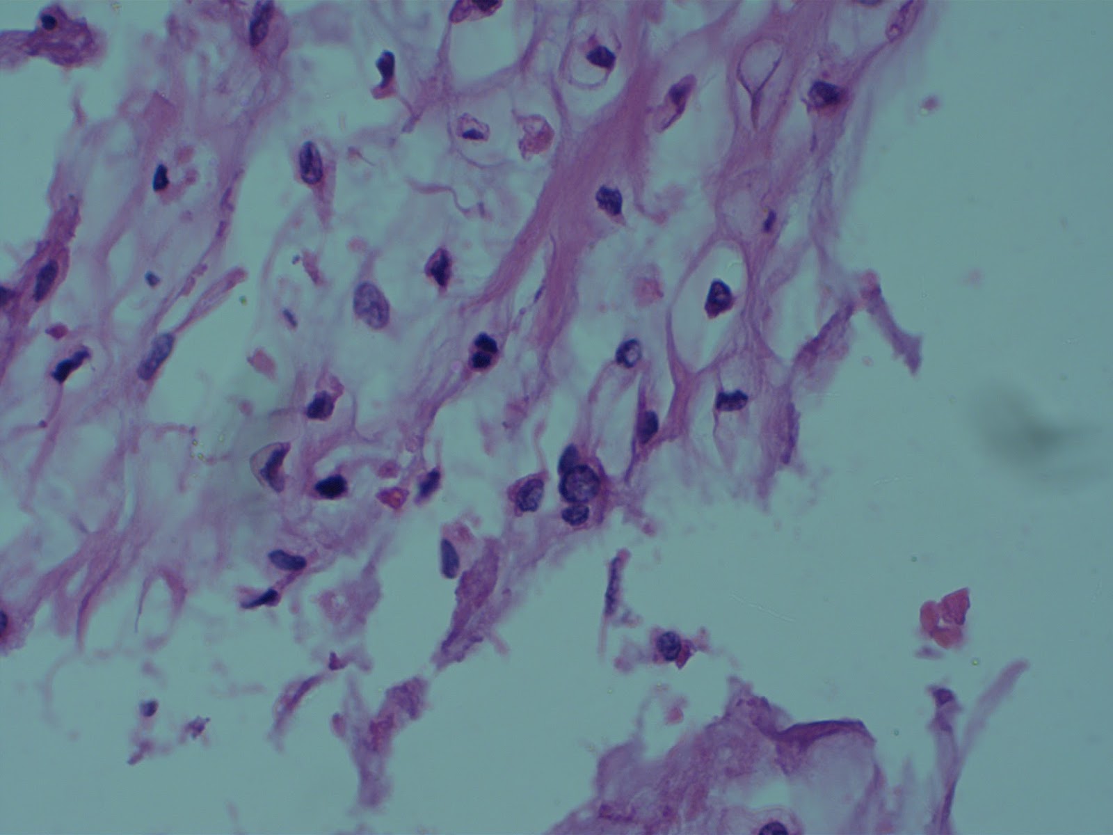 dr pankaj goel: Chondrosarcoma of the Sternum- Radical Excision and ...