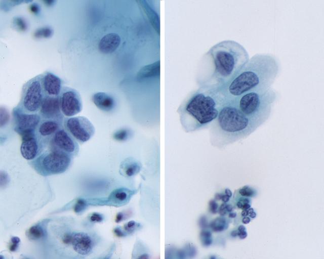 Estudio de los cambios celulares del cuello uterino. (Malignidad ...