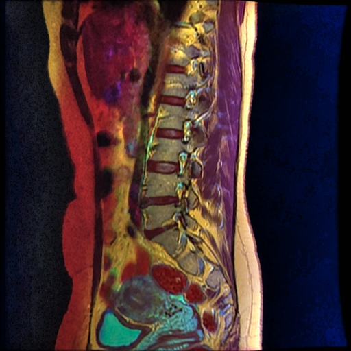 Nevit's blog: Color MRI of the Lumbar spine with extruded disc