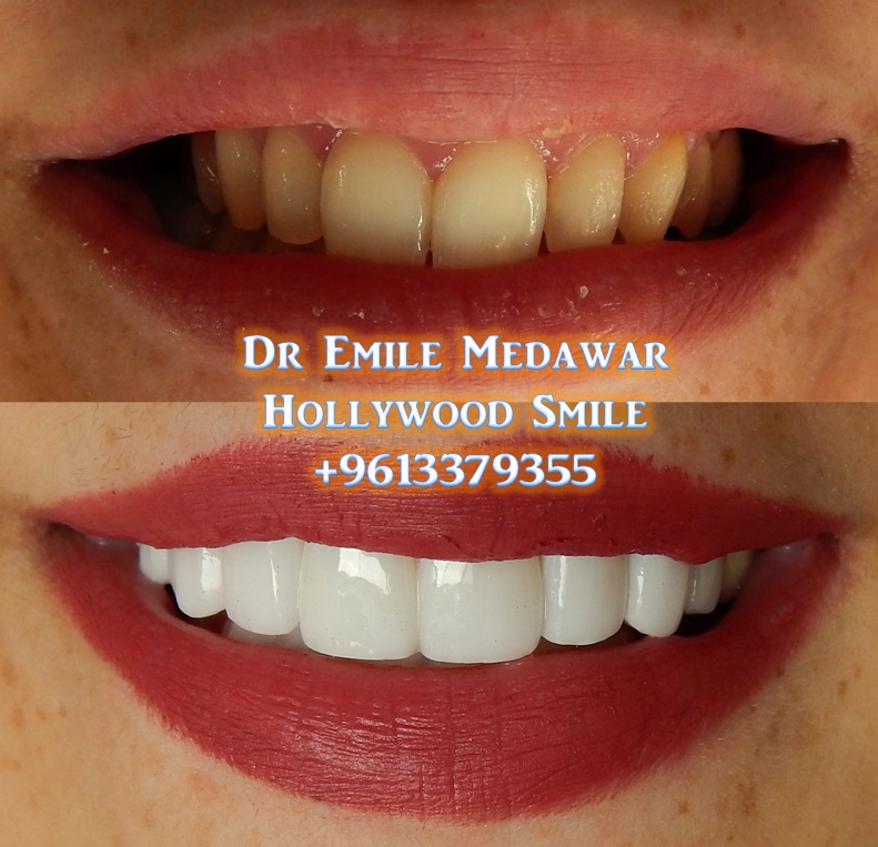 Beautiful Lebanese Smile, Dr Emile Medawar, 00 961 3 379355: The Best ...