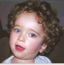 Medical Treatment Pictures-for Better Understanding: Canavan Disease