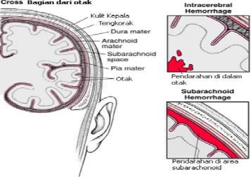 Penyakit Stroke: September 2011