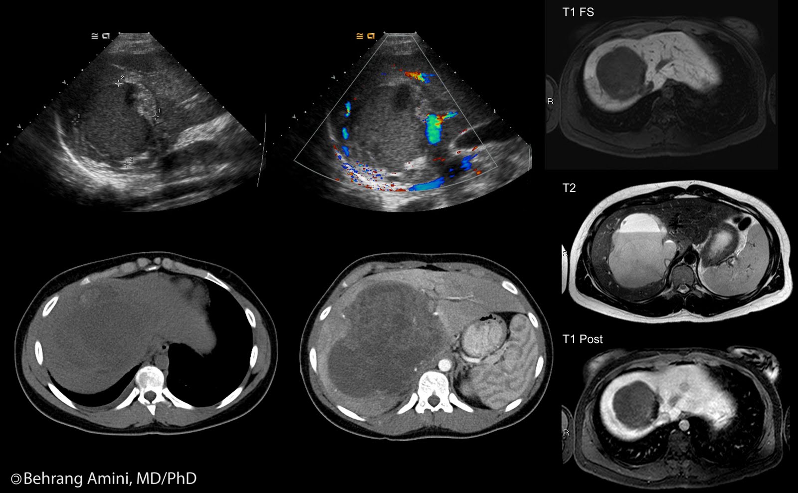 Roentgen Ray Reader: Undifferentiated (Embryonal) Sarcoma of the Liver