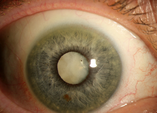 Katarakt Ameliyatı ~ Op. Dr. Sinan Bilgin