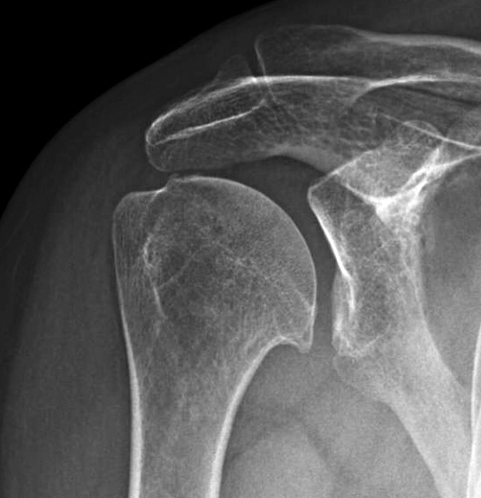 UW Shoulder and Elbow Academy: Glenoid dysplasia - evaluation and ...