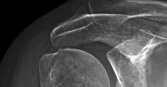 UW Shoulder and Elbow Academy: Glenoid dysplasia - evaluation and ...