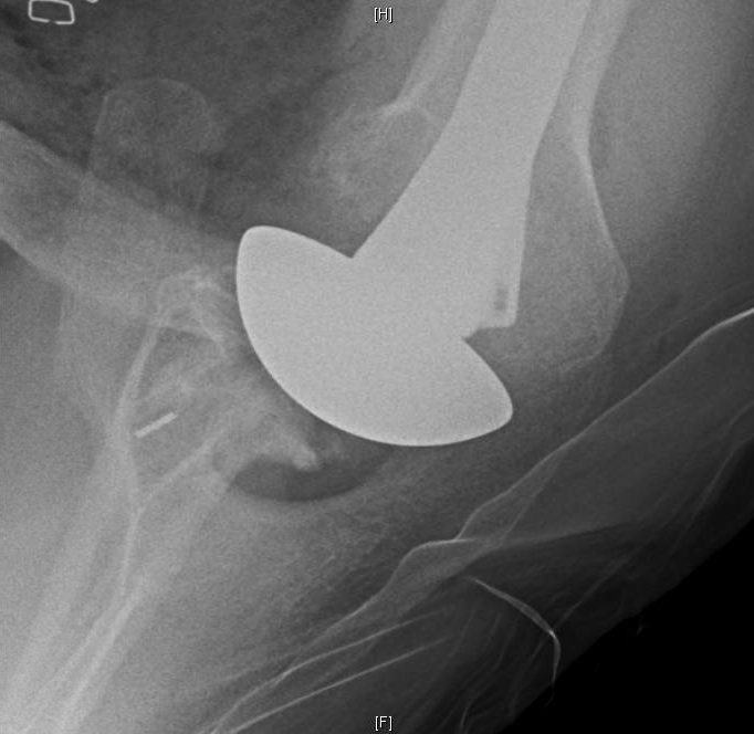 Shoulder Arthritis / Rotator Cuff Tears / Shoulder Pain : Managing ...