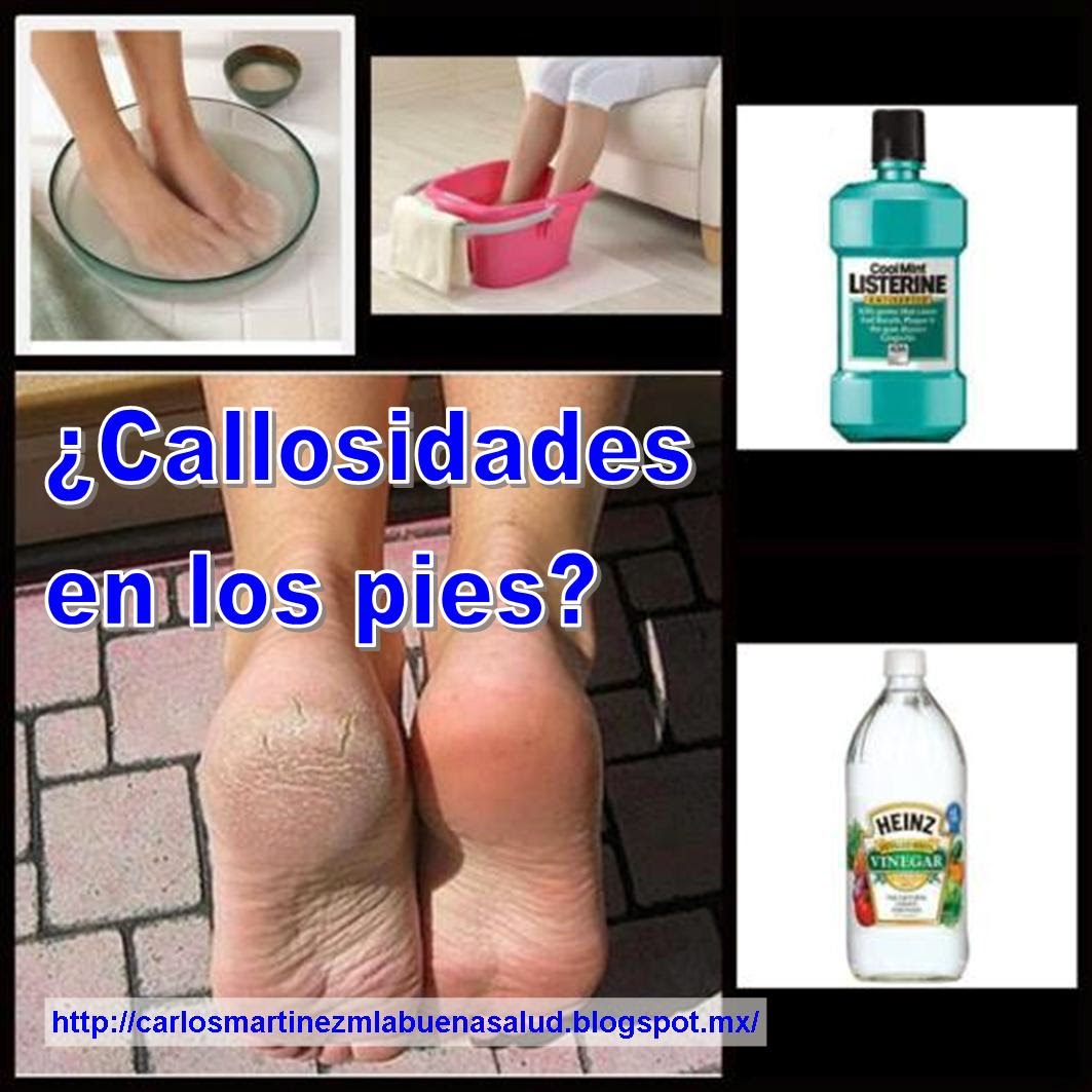 Carlos Martinez M_La Buena Salud al alcance de Todos: ¿CALLOSIDADES EN ...