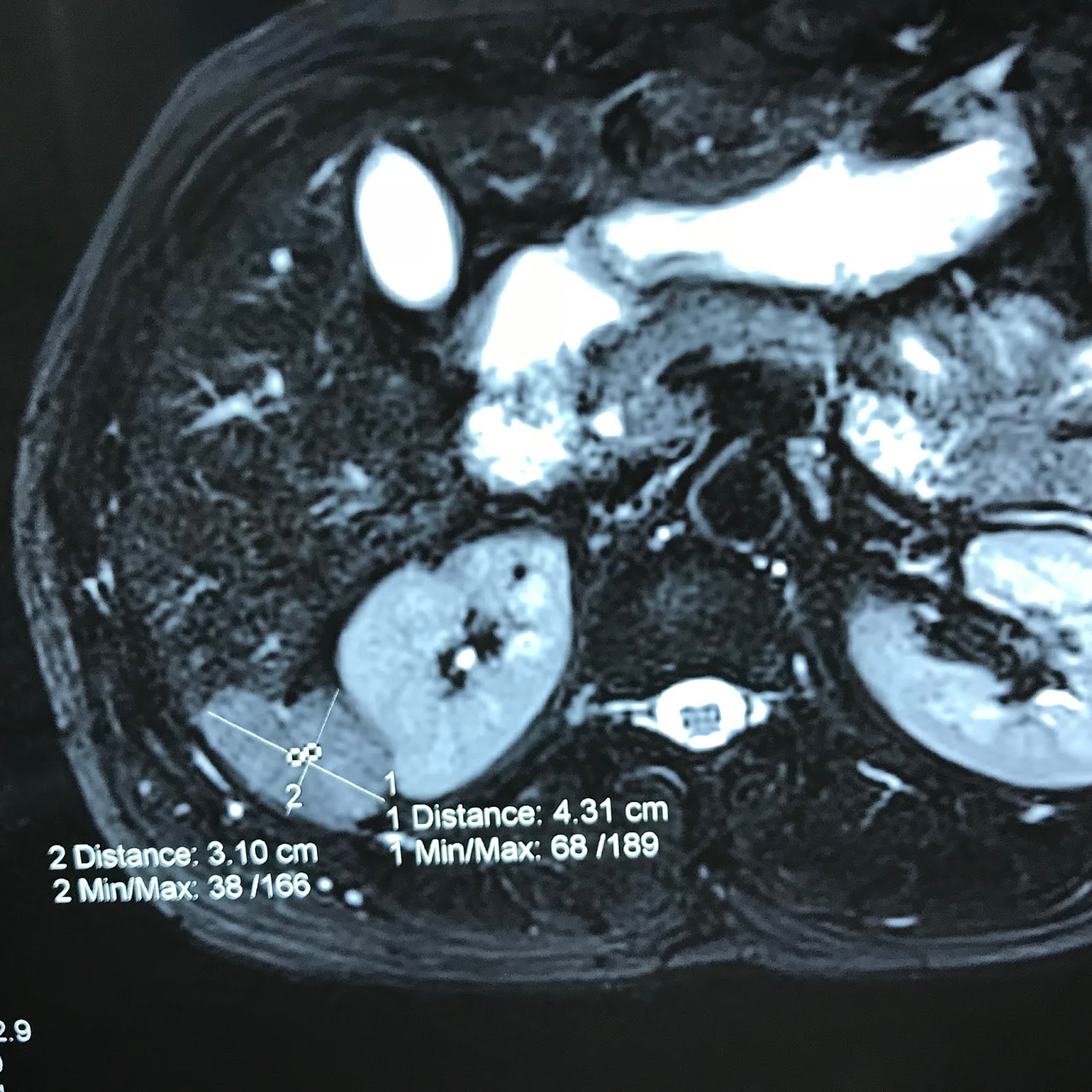 VIETNAMESE MEDIC ULTRASOUND: CASE 482 : SPLENOSIS, Dr PHAN THANH HẢI ...