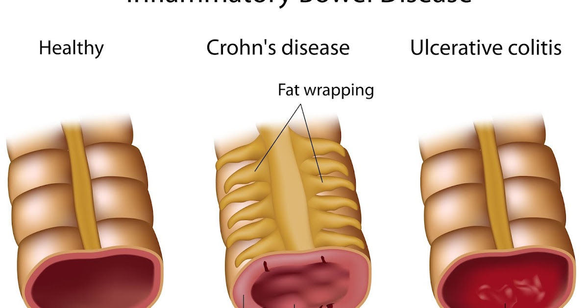 Gi Endoscopy Practice: What is an anal fissure?