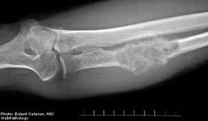 Types de cancer des os - Cause et symptômes du cancer des os - Articles ...