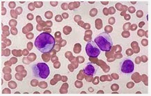 Akut Limfoblastik Leukemia
