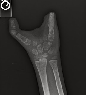 Symbrachydactyly, now what? | Congenital Hand and Arm Differences ...