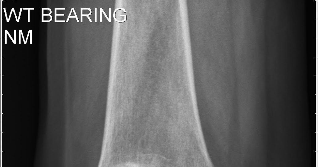 Total Knee Replacement (TKR)
