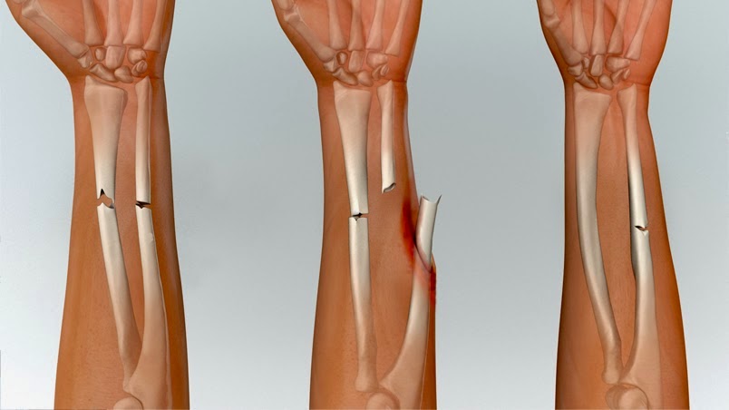 Health and Beauty Blog: KONSEP FRAKTUR