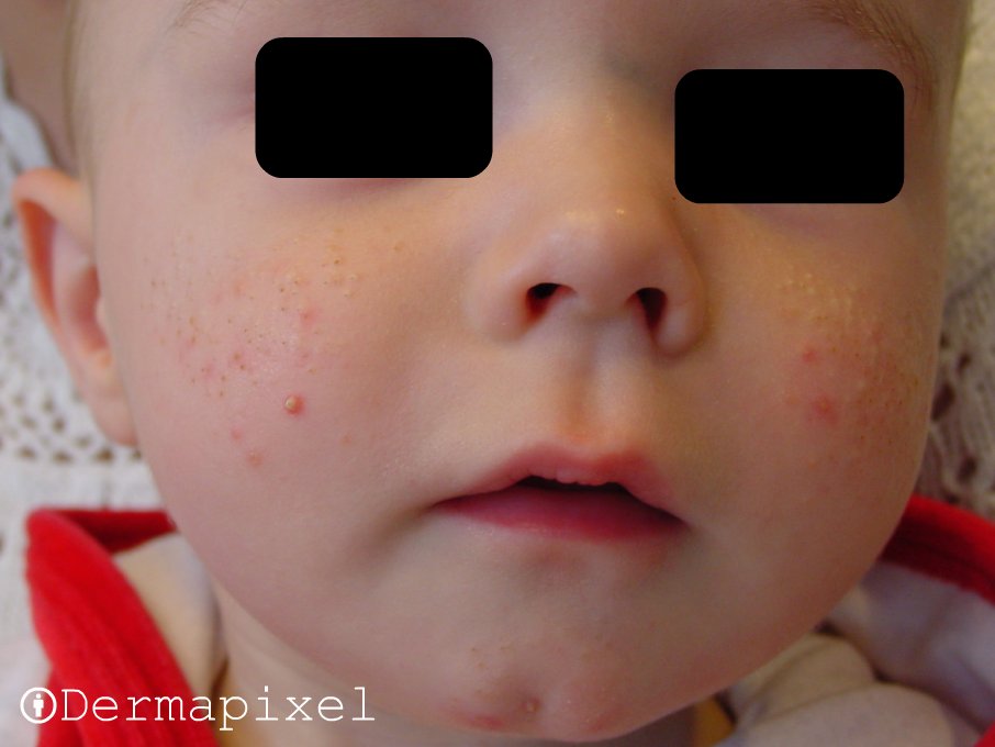 Dermapixel: Un acné demasiado juvenil