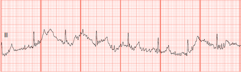 Basic EKG Rhythm Test 45