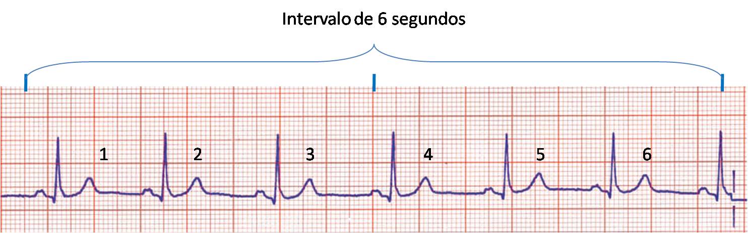 Tutomedic: RUTINA DE INTERPRETACIÓN DEL ECG:1- Frecuencia