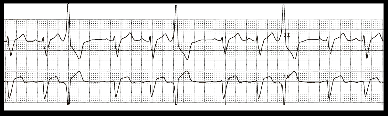 EKG Rhythm Quiz 241