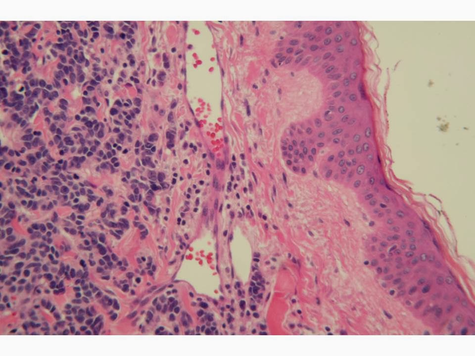 Dermpath Made Simple - Neoplastic: Merkel Cell Carcinoma