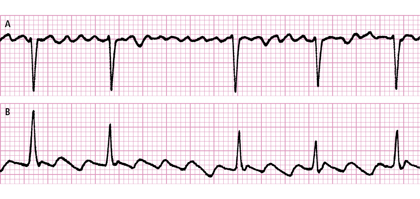 Ecuarritmias: Taquicardias supraventriculares: ¿Qué son y qué tipos hay?