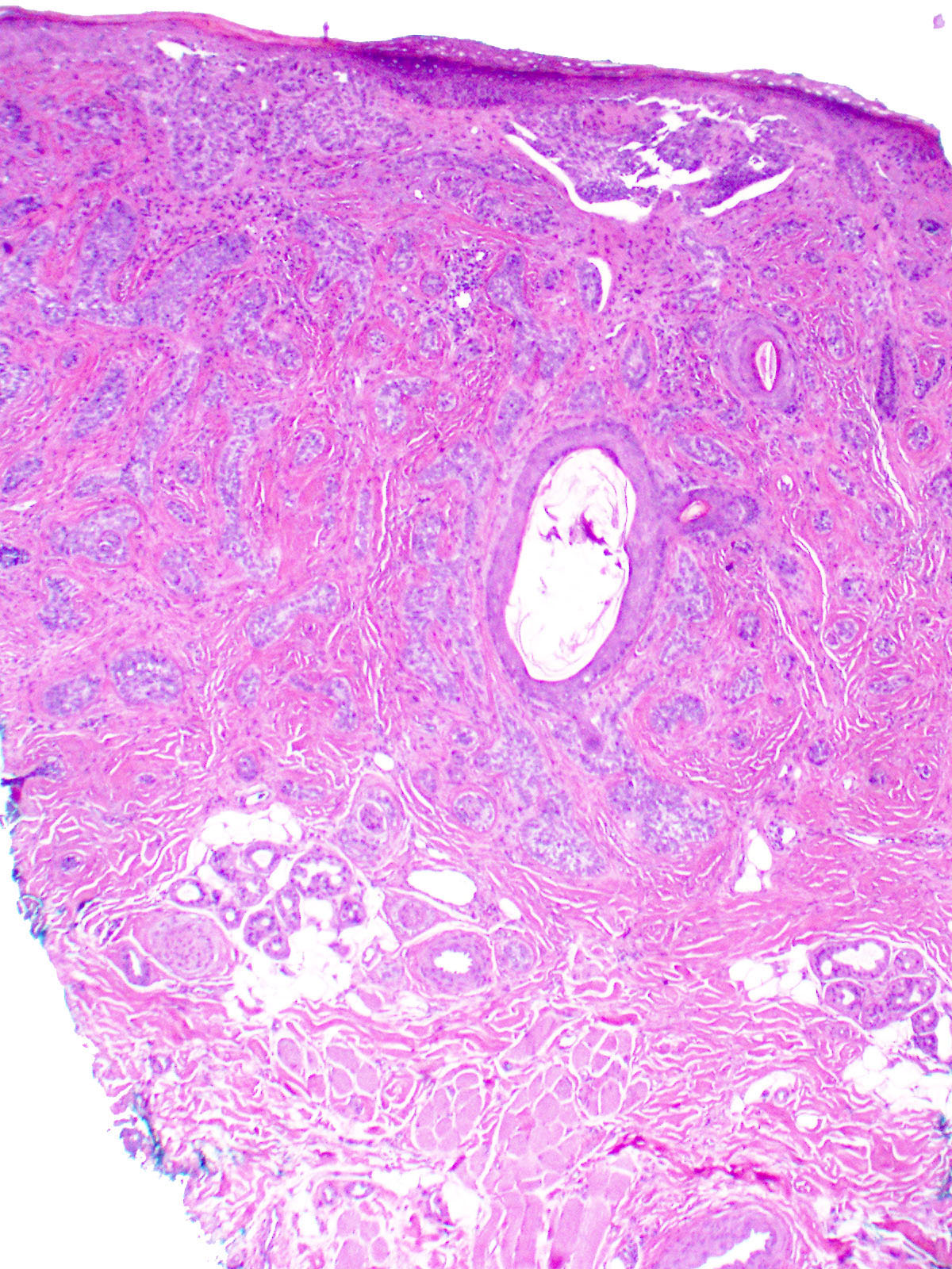 Virtual Grand Rounds In Dermatology 2 0 Recurrent Bcc With Perineural