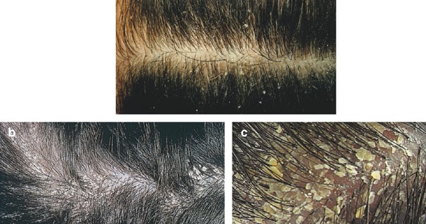 Dandruff