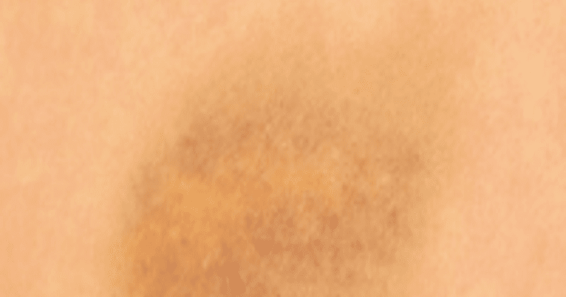 Apa Itu Memar Pada Anak Dan Cara Mengobati Memar - Klinikabar