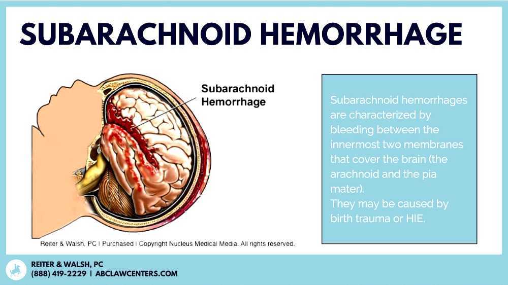 Subarachnoid hemorrhage