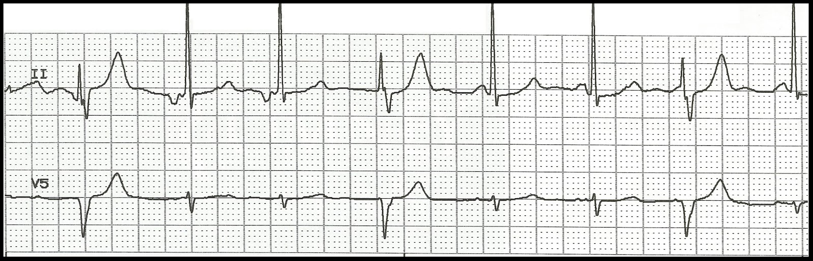 Practice EKG Rhythm Strips 171