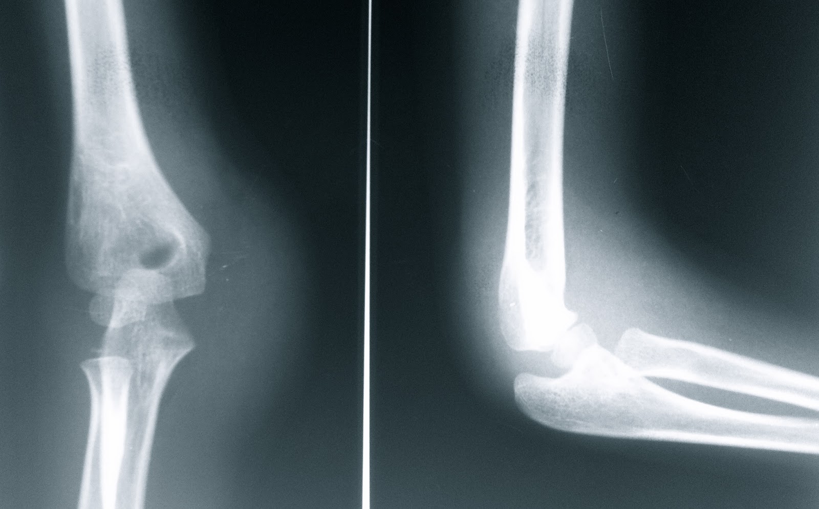 Radiologia Pediátrica: AVULSÃO DO EPICÔNDILO MEDIAL UMERAL