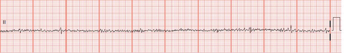 EKG Rhythm Strip Quiz 23