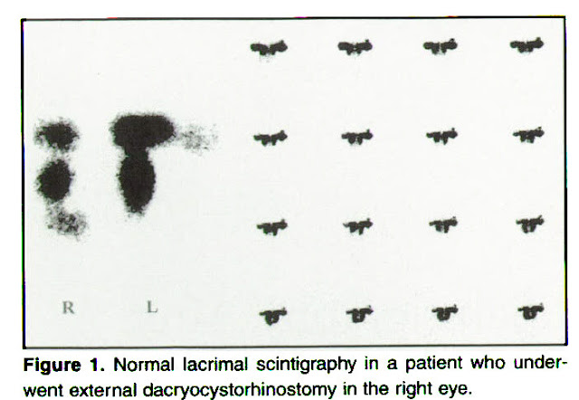 The watery eye, its common cause, and step wise approach - Eye Health Nepal