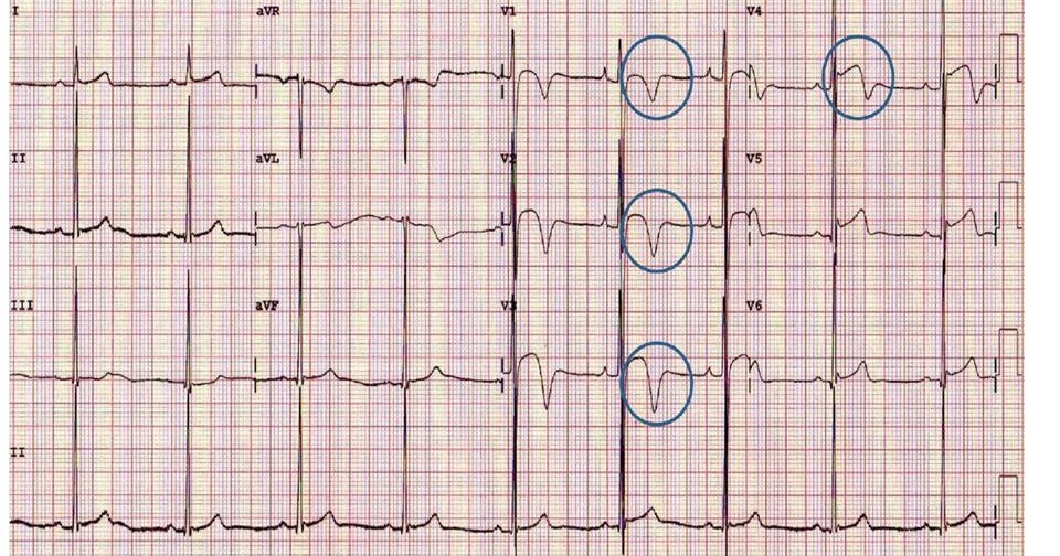 Hallazgos Anormales en ECG Atletas (I). International recommendations ...