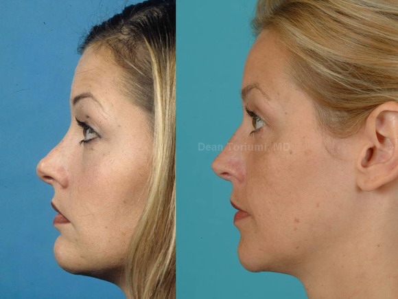 Dr. Dean Toriumi Reviews: Secondary Rhinoplasty surgeries