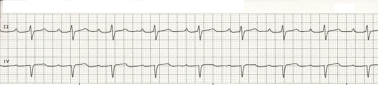 ACLS Rhythms: Heart blocks