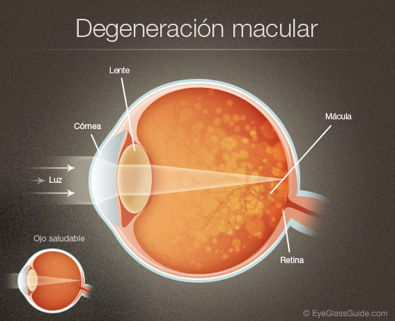 Immunotec Yucatan: Degeneracion macular