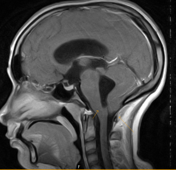Posterior Fossa Arachnoid Cyst & Tonsillar Descent - Sumer's Radiology Blog
