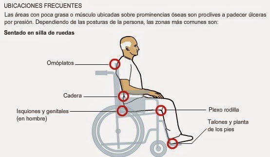 ENFERMERÍA: ULCERAS POR DECUBITO