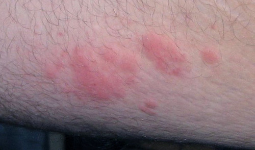 Stress Rash Pictures | Medical Pictures and Images - (2023 Updated)