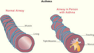 Functional Health Patterns for Asthma - IT News