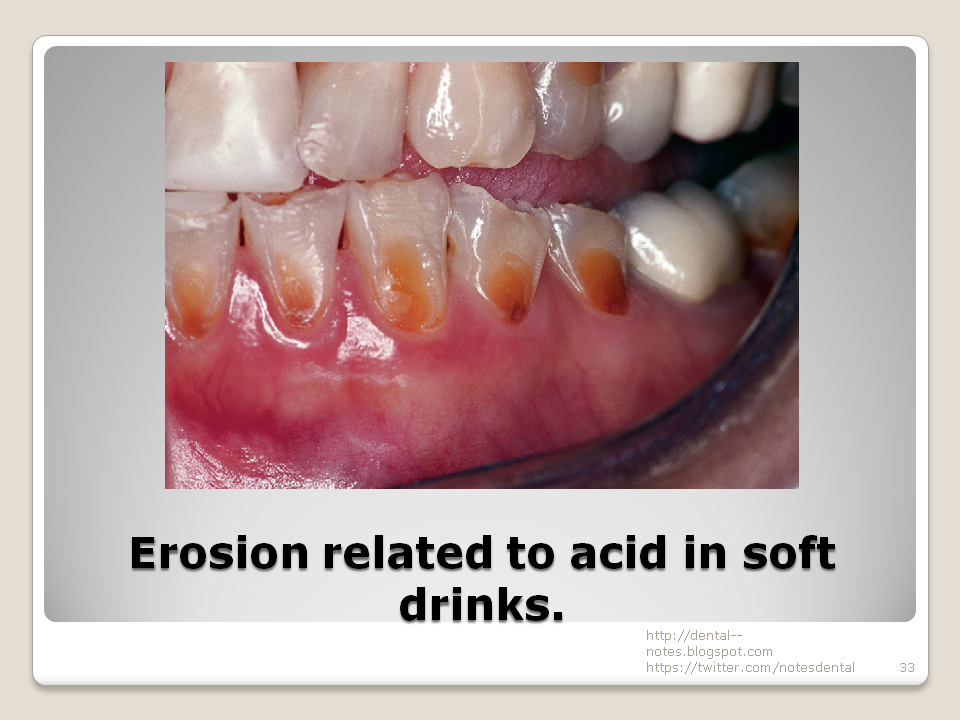 Dental Notes: Abnormalities of Teeth (Alterations in Shape) NOTES