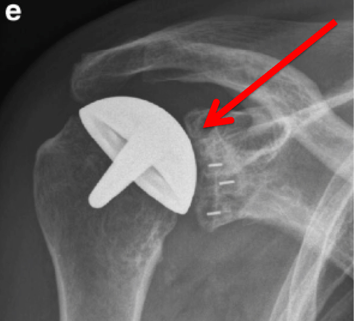 Shoulder Arthritis / Rotator Cuff Tears / Shoulder Pain : Resurfacing ...