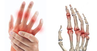 HOW TO GET RID OF ARTHRITIS IN FINGERS