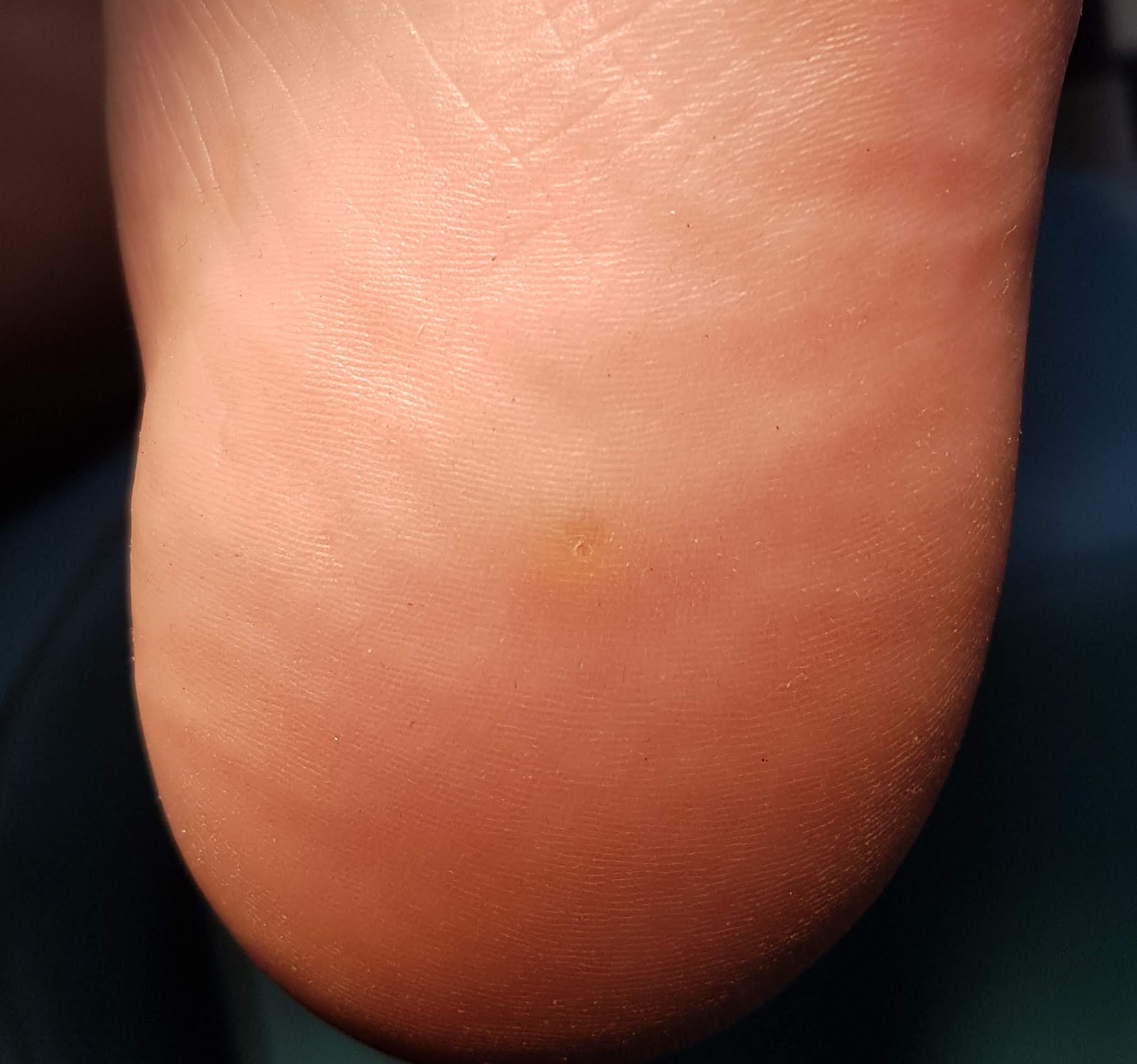 Podo Basas al Día: Matricectomía total con K-Láser Cube 4. Exostectomía ...