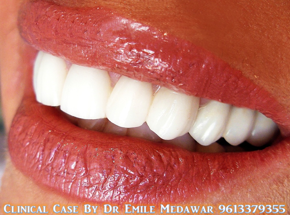 Teeth Hollywood Smile, Dr Emile Medawar, 00 961 3 379355 : Dr Emile ...