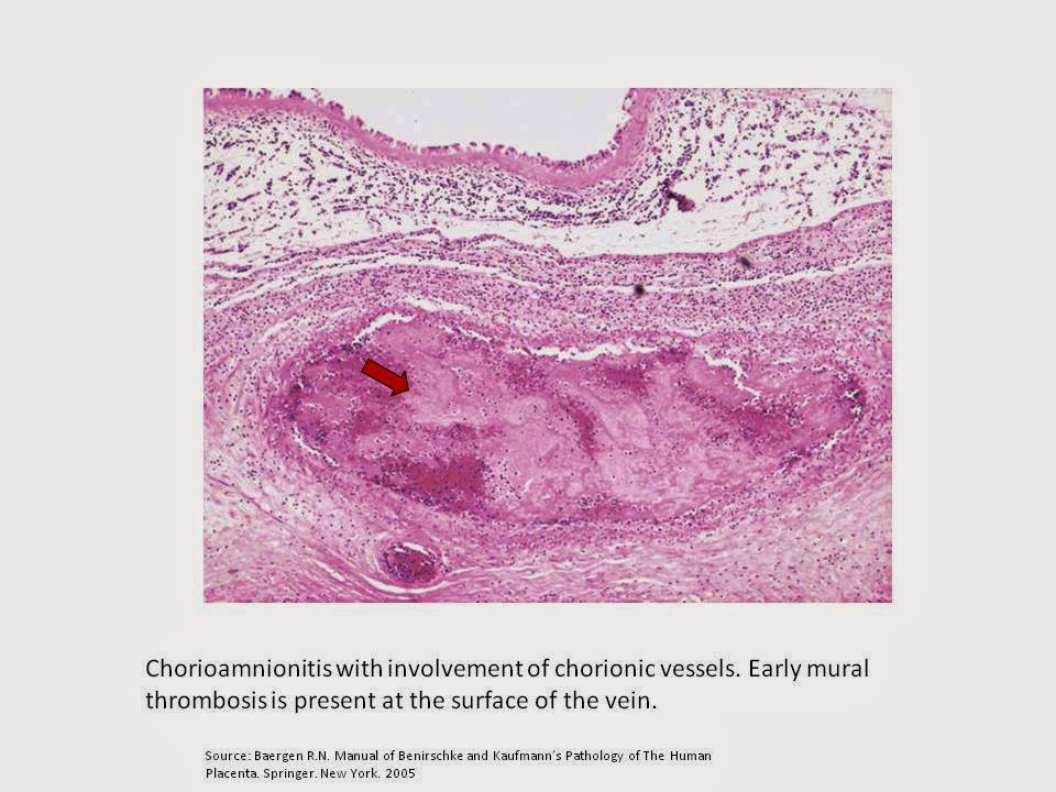 Reza Aditya Digambiro: Chorioamnionitis